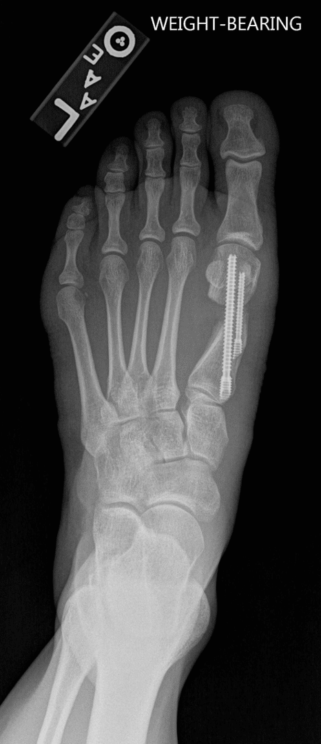 Hallux Valgus - Dr Anthony Bradshaw - Wagga Orthopaedics and Sports Surgery